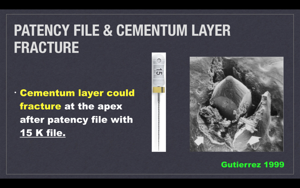Apical Patency - まつうら歯科医院 歯内療法専門室