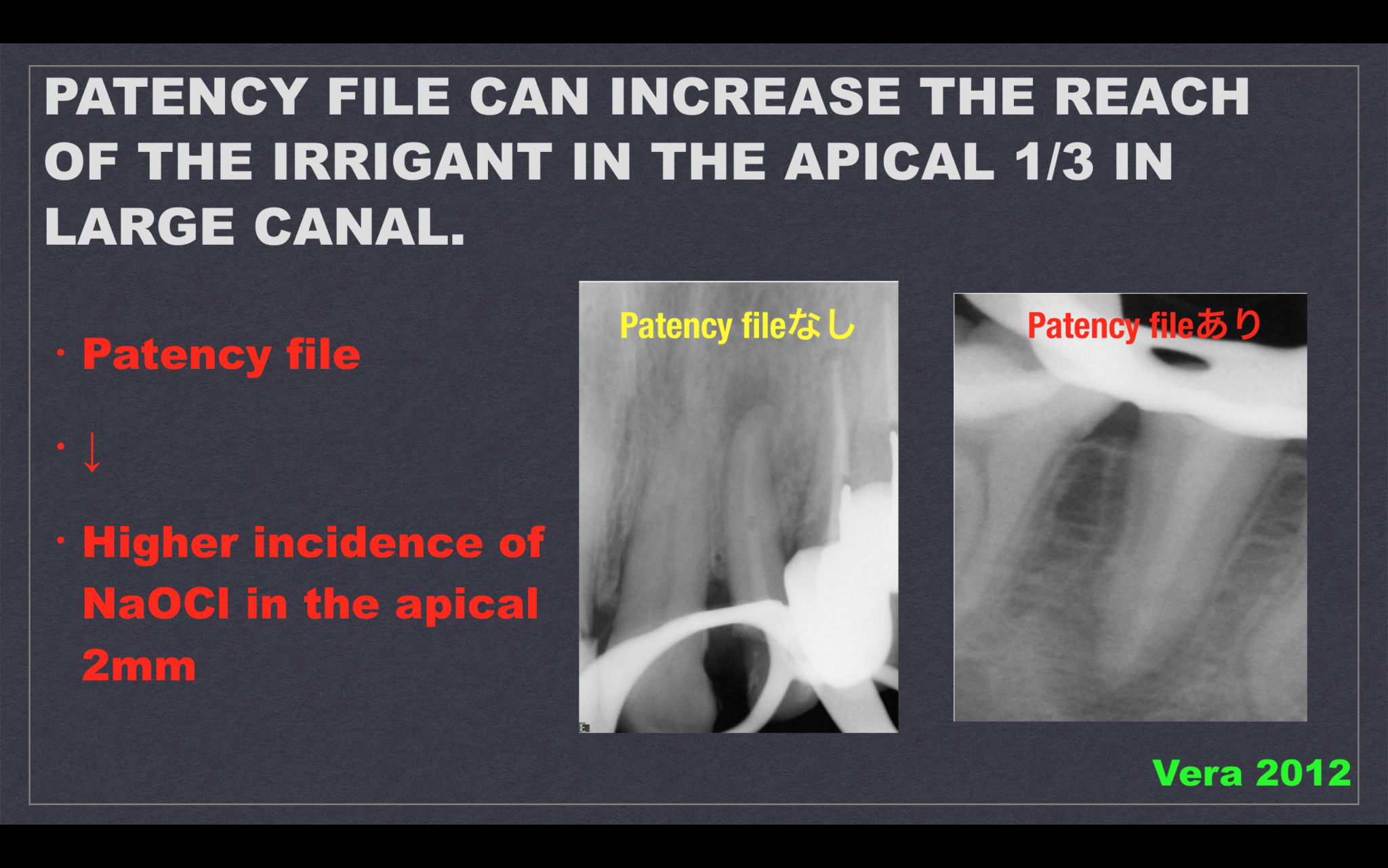 Apical Patency - まつうら歯科医院 歯内療法専門室