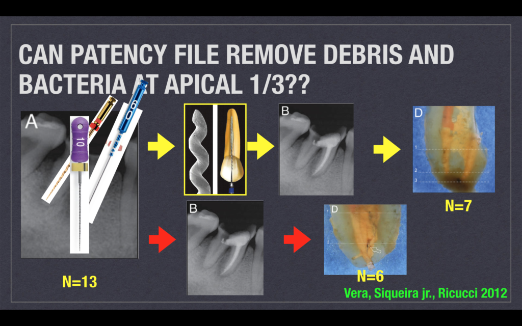 Apical Patency - まつうら歯科医院 歯内療法専門室
