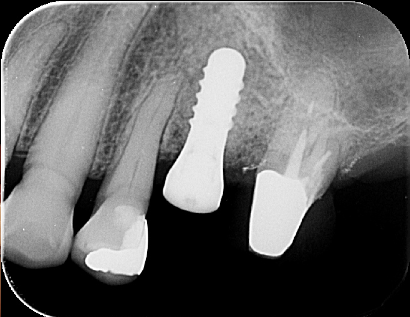 #13 Apicoectomy⇨Ext+GBR⇨Implant埋入, #14 DB Apicoectomy, MB Root ...