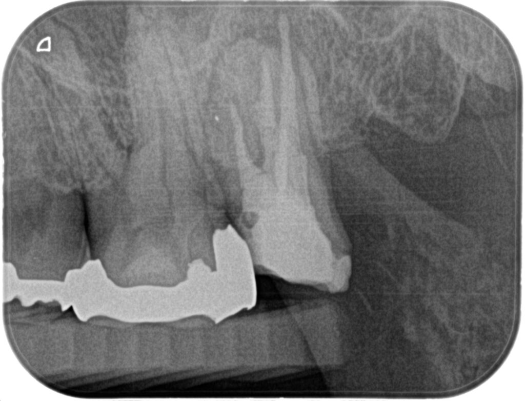 MTAのOverextensionは悪か？〜#15 Re-RCT+Core build up with Fiber Post 6M ...