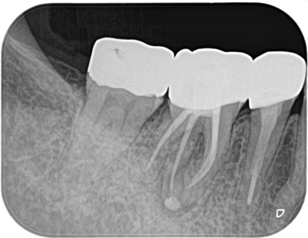 #30 M, D, Radix Entomolarisにそれぞれ根尖病変を有する歯のInitial RCT(1回法)+Core build ...