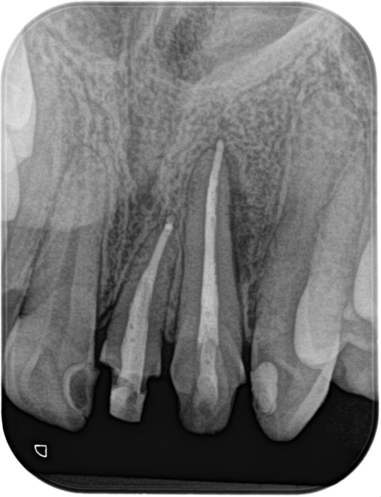 除去が難しい既成ピンを有する再根管治療〜#9 Re-RCT+Core build up with Fiber Post - まつうら歯科医院 ...