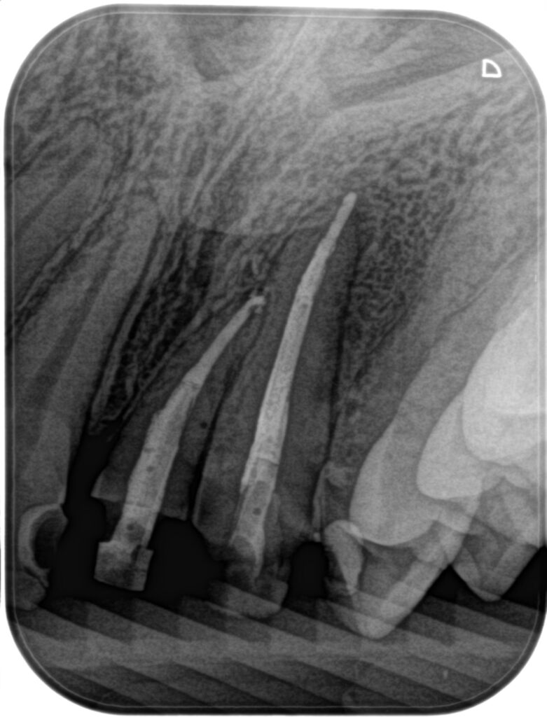 除去が難しい既成ピンを有する再根管治療〜#9 Re-RCT+Core build up with Fiber Post - まつうら歯科医院 ...