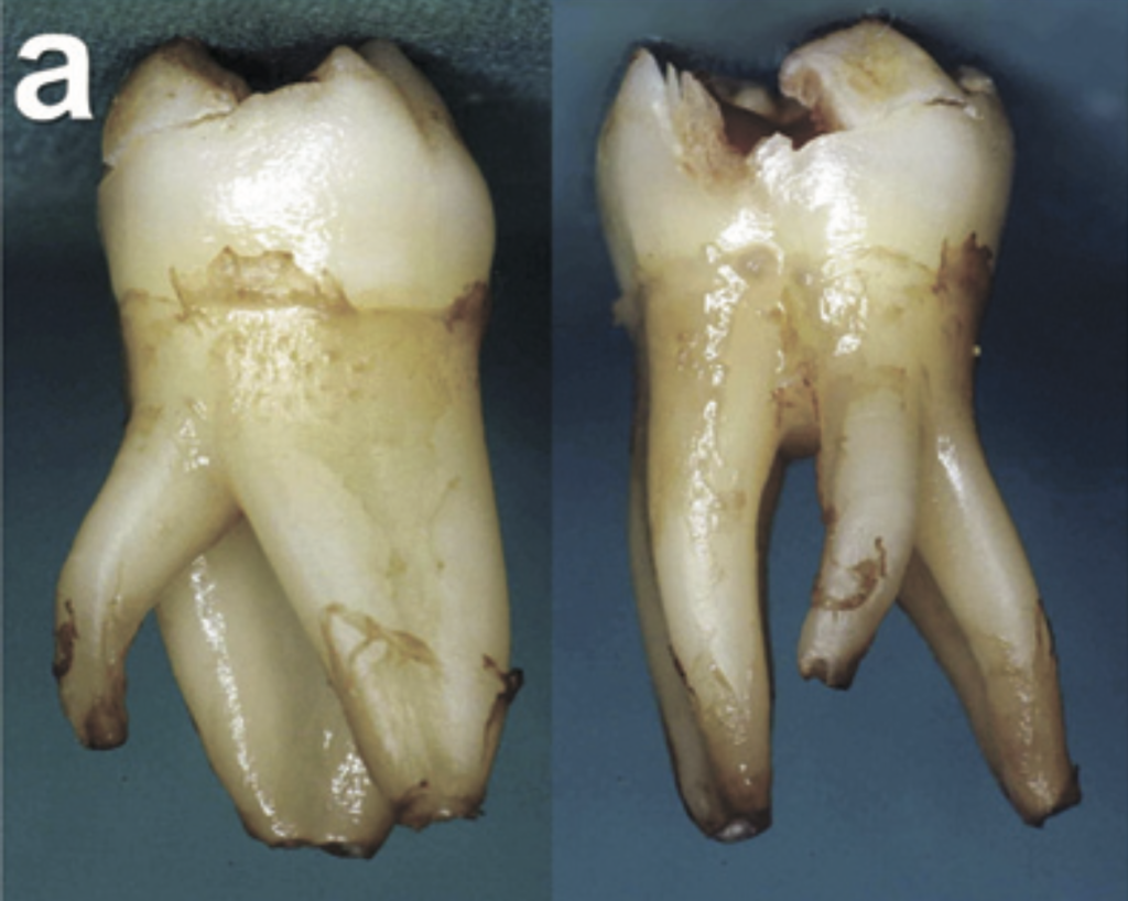 #30 M, D, Radix Entomolarisにそれぞれ根尖病変を有する歯のInitial RCT(1回法)+Core build ...