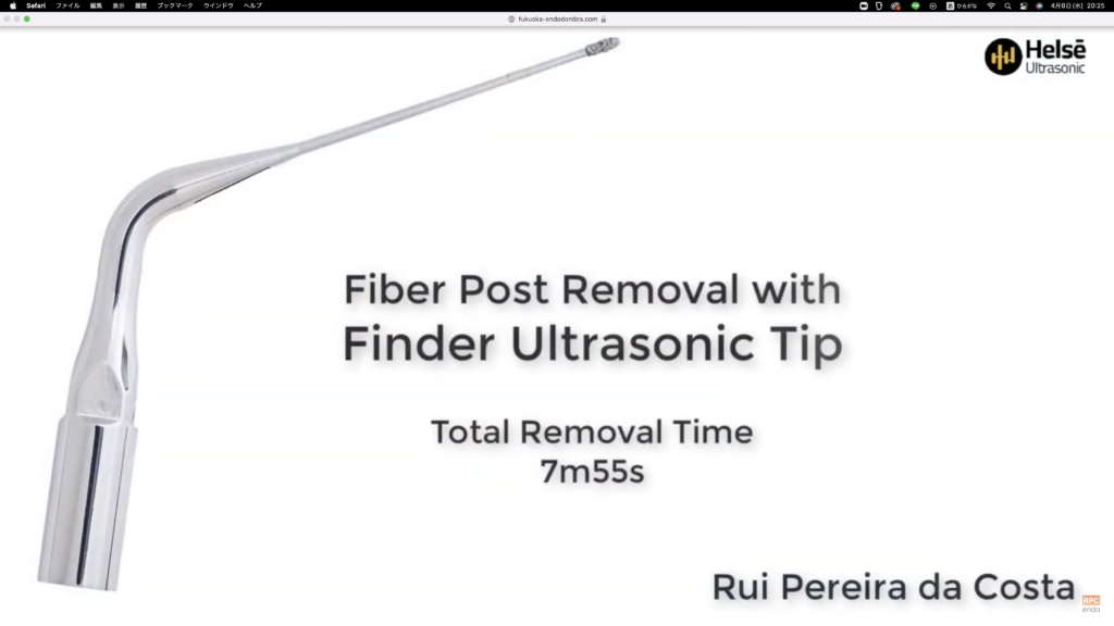 除去が難しい既成ピンを有する再根管治療〜#9 Re-RCT+Core build up with Fiber Post - まつうら歯科医院 ...