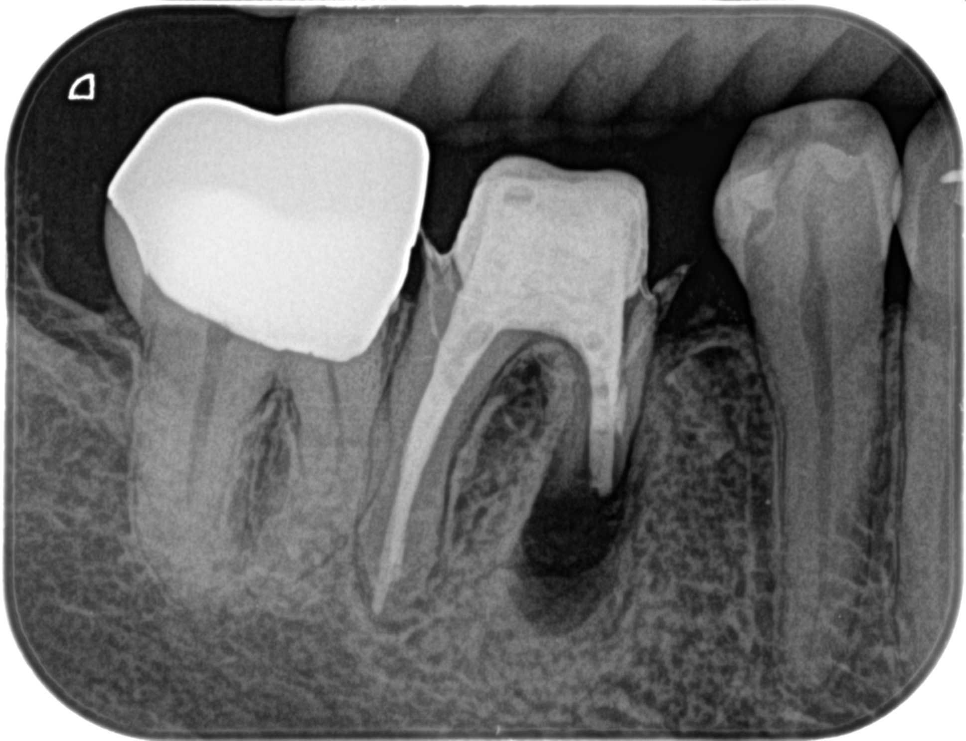 治療した歯が痛い？〜#30 Apicoectomyから半年経過 - まつうら歯科医院 歯内療法専門室