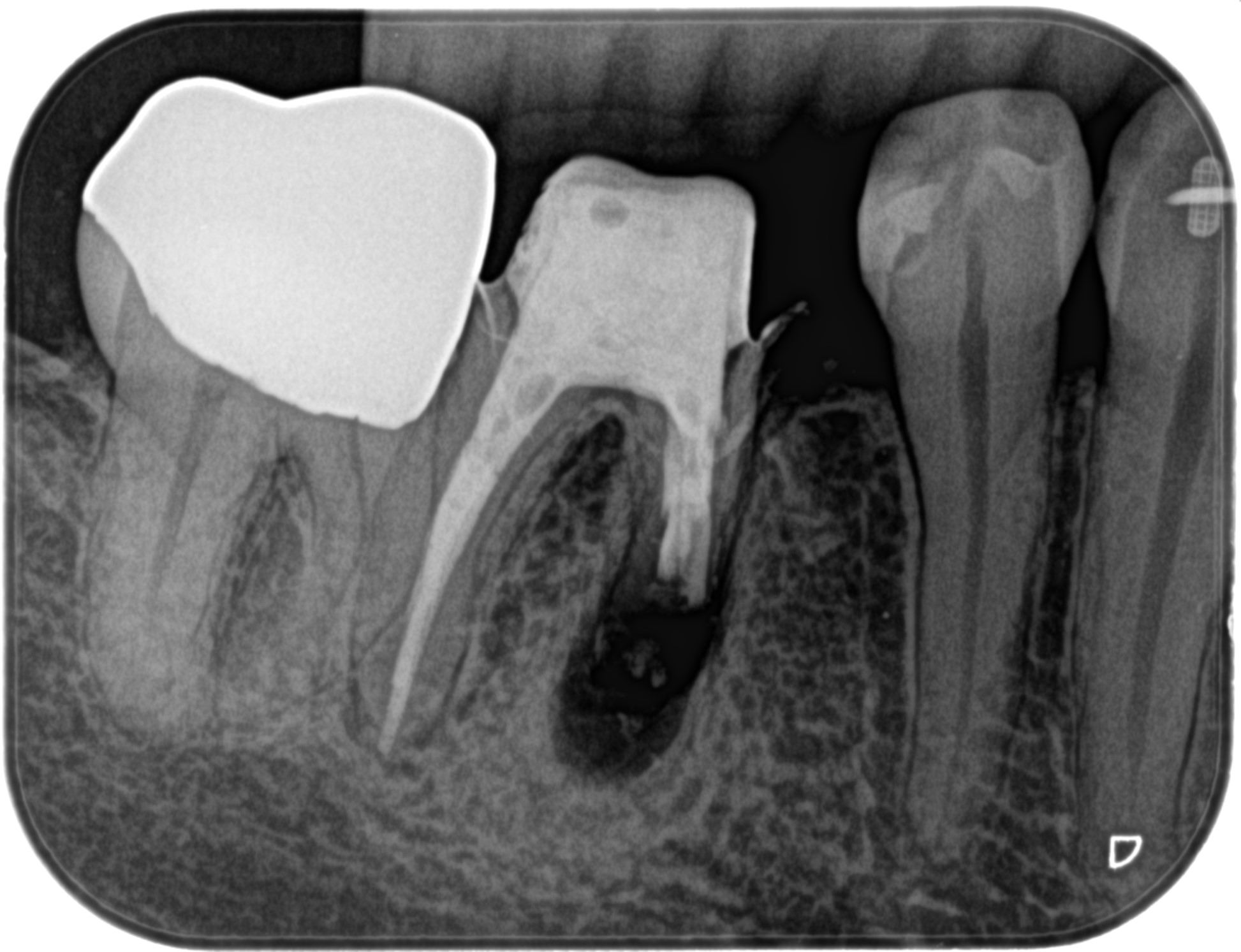 治療した歯が痛い？〜#30 Apicoectomyから半年経過 - まつうら歯科医院 歯内療法専門室