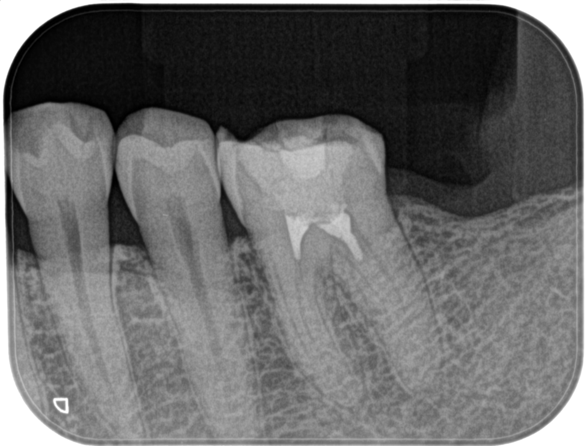 同業者の歯科治療〜#19 RCT+Core build up - まつうら歯科医院 歯内療法専門室