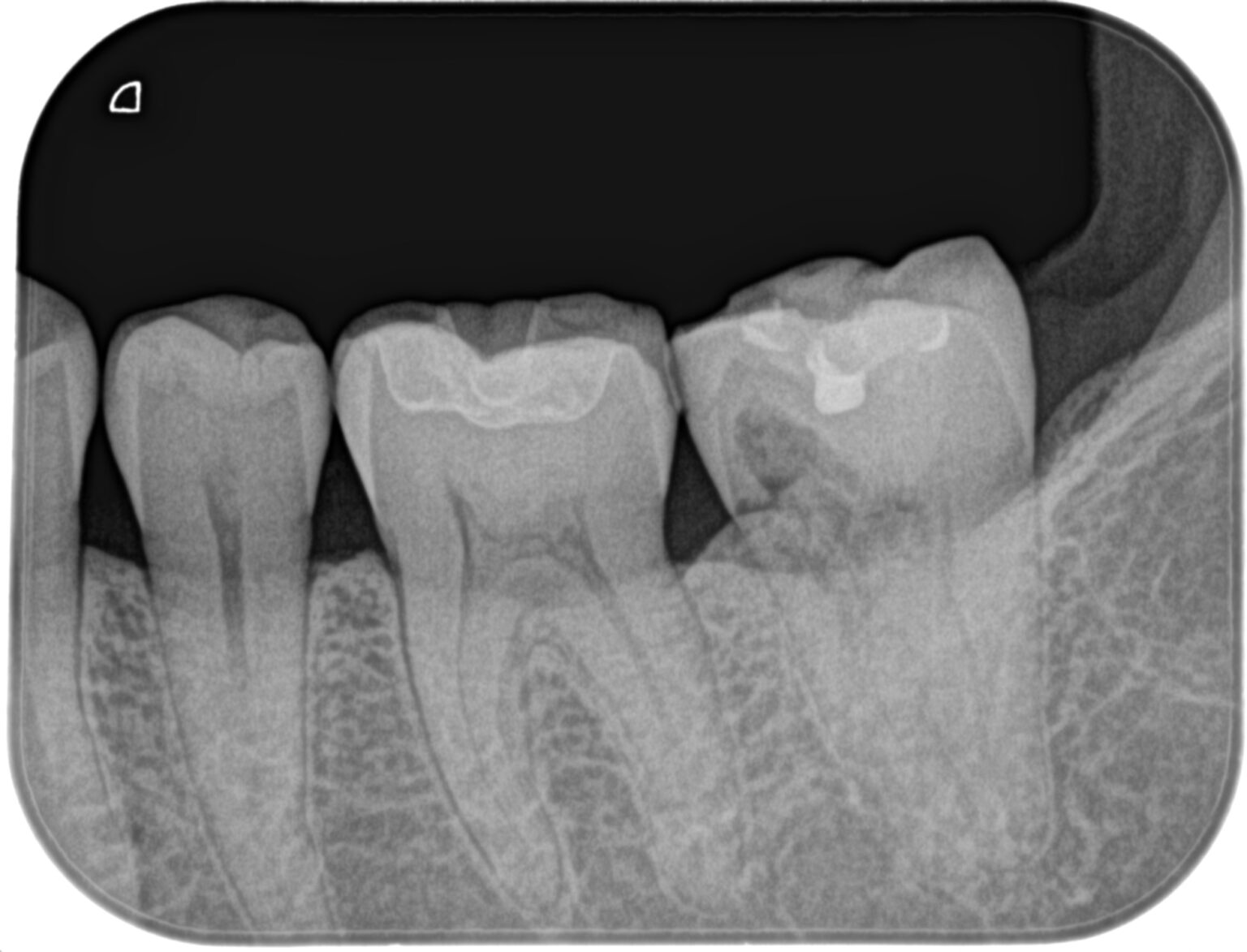 #18 侵襲性歯頸部外部吸収（Invasive Cervical Root Resorption）の治療計画の立案 - まつうら歯科医院 歯内 ...