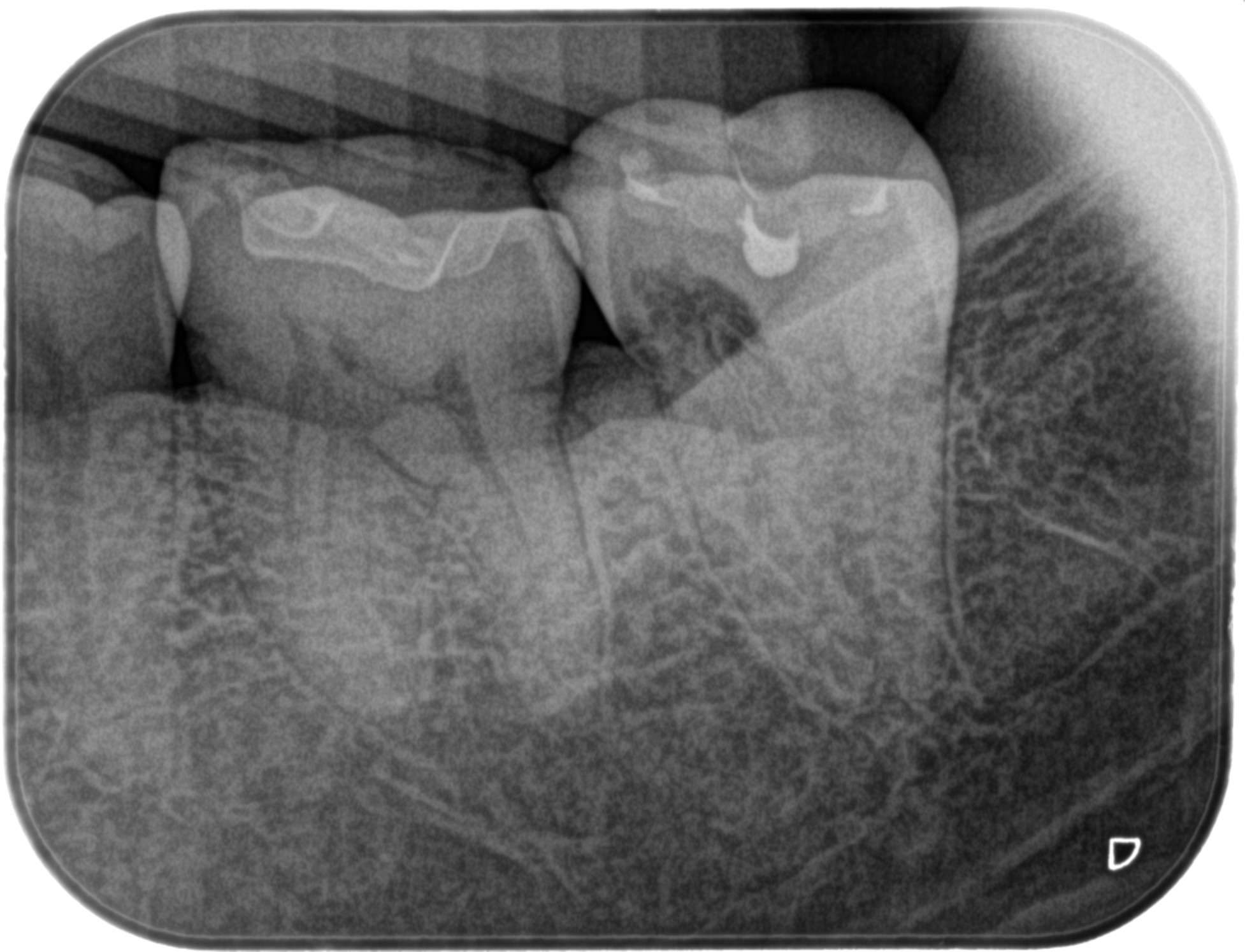 #18 侵襲性歯頸部外部吸収（Invasive Cervical Root Resorption）の治療計画の立案 - まつうら歯科医院 歯内 ...