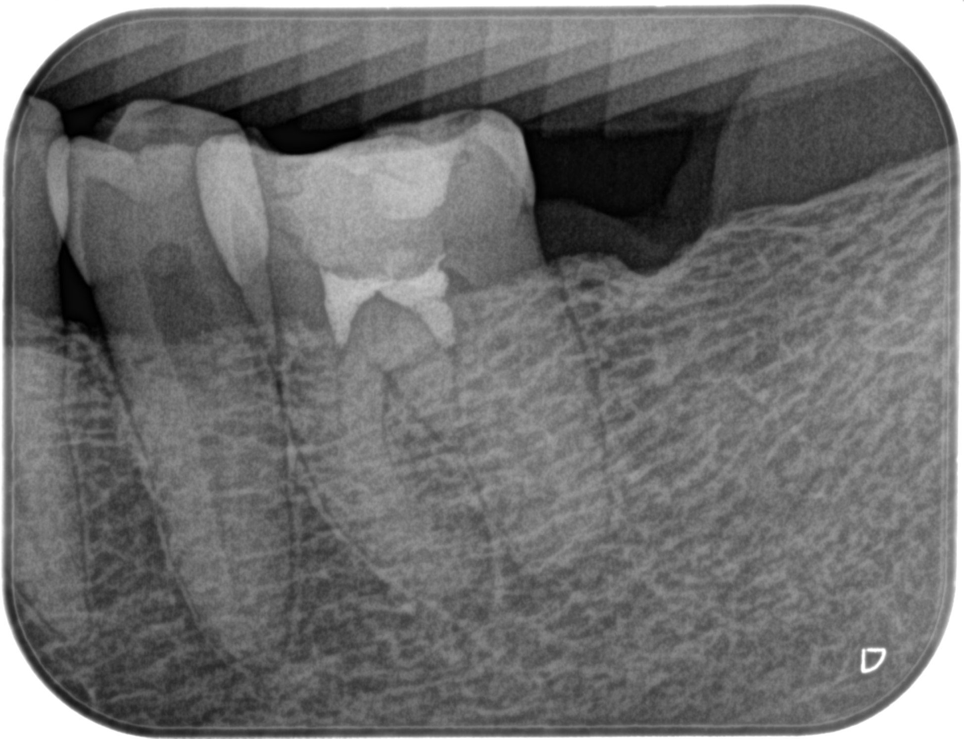 同業者の歯科治療〜#19 RCT+Core build up - まつうら歯科医院 歯内療法専門室