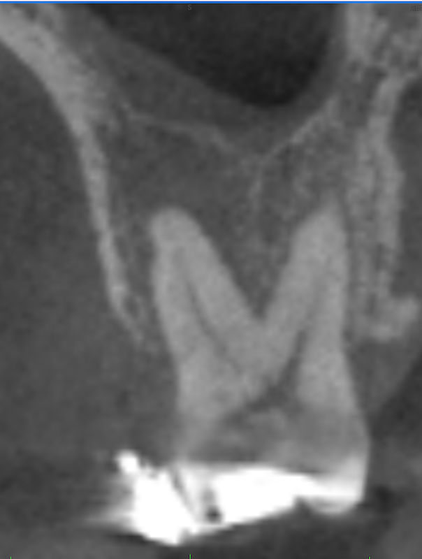 矯正治療中からずっと痛い右上奥歯…なぜ？？〜#3 RCT+Core build up - まつうら歯科医院 歯内療法専門室