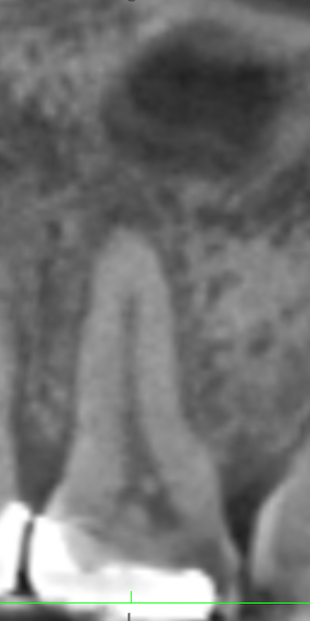 矯正治療中からずっと痛い右上奥歯…なぜ？？〜#3 RCT+Core build up - まつうら歯科医院 歯内療法専門室