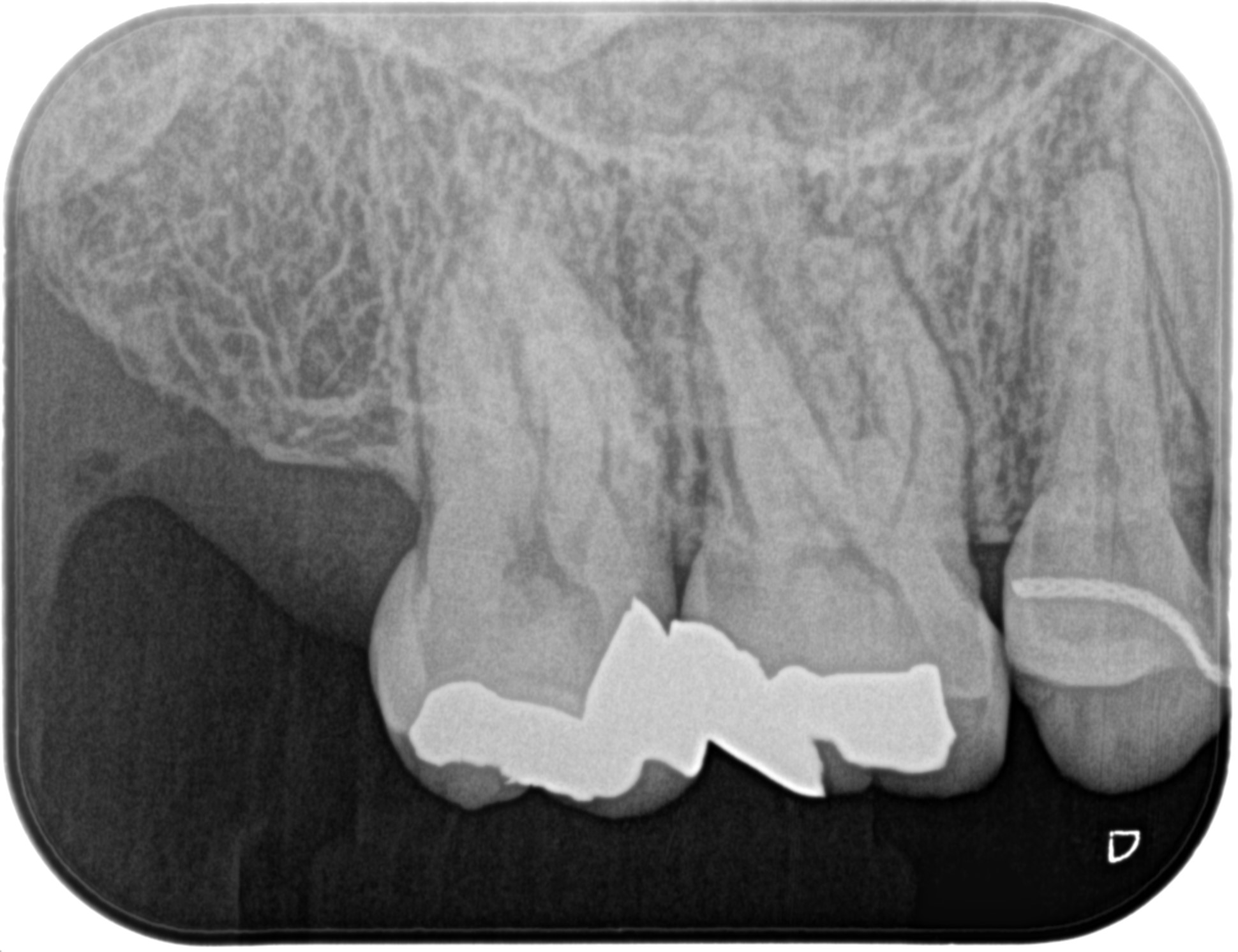 矯正治療中からずっと痛い右上奥歯…なぜ？？〜#3 RCT+Core build up - まつうら歯科医院 歯内療法専門室