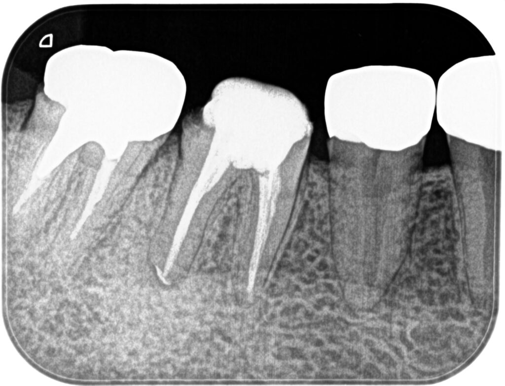 根管内から多量のブローチ綿花が…勤務医時代を思い出す#30 Re-RCT+Core build up with Fiber Post ...