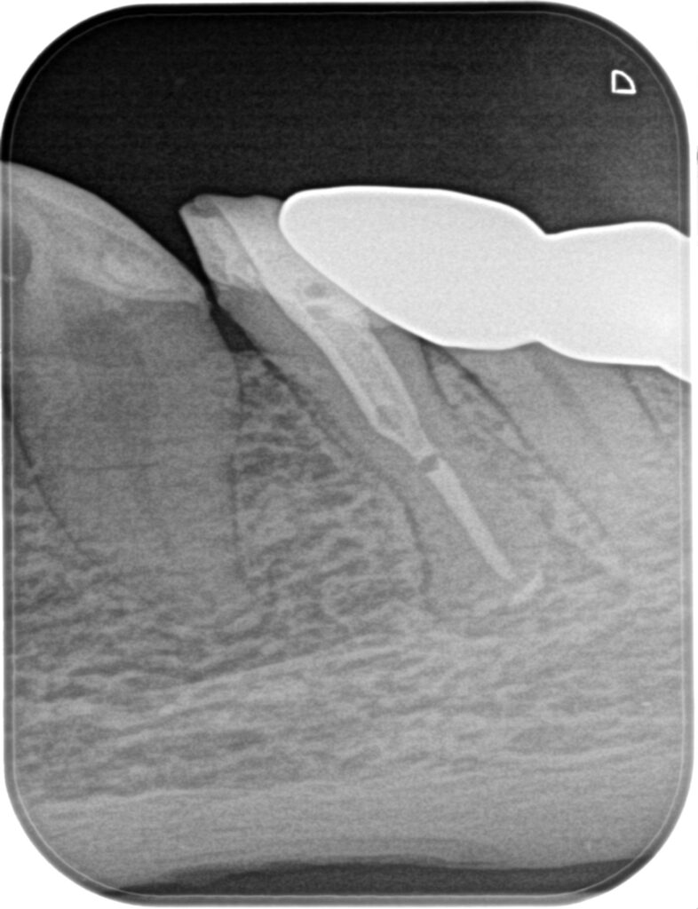 尖通するか？しないか？〜#21 Re-RCT+Core Build up with Fiber Post - まつうら歯科医院 歯内療法専門室