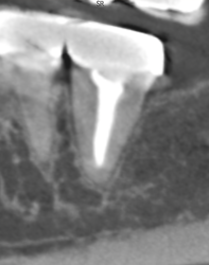 極めて成功率の高い再根管治療の内容とは？〜#18 Re-RCT+Core build up with Fiber Post - まつうら歯科 ...