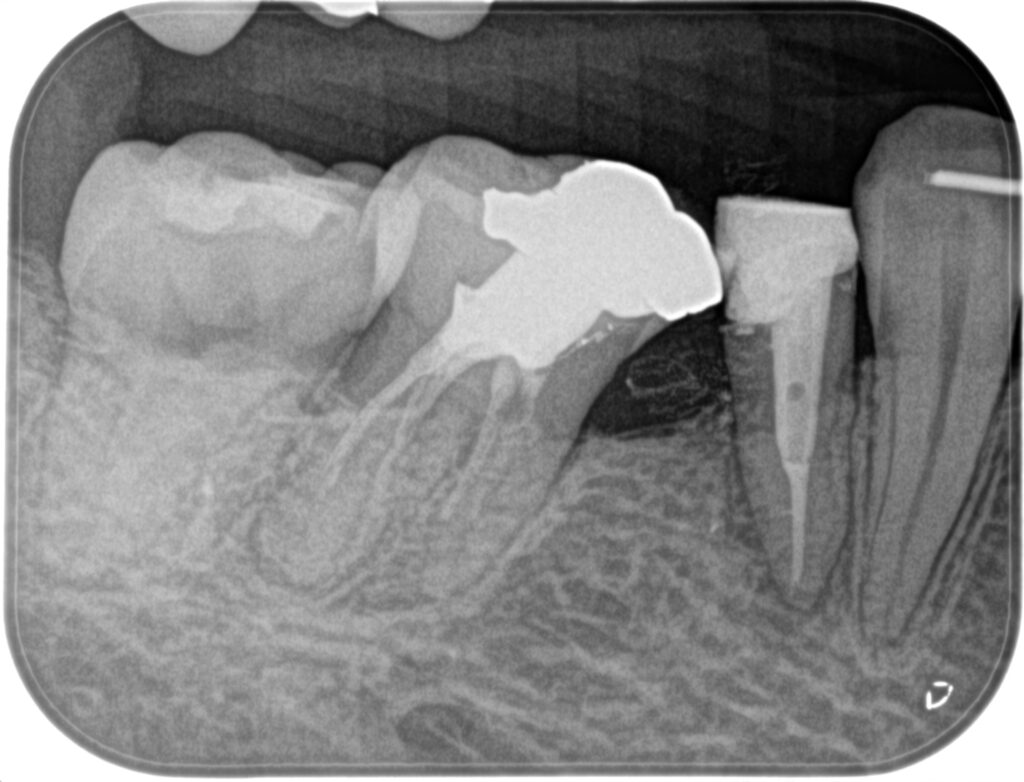 様々な再根管治療のテクニックが詰まった#29 Re-RCT+Core build up with Fiber Post 1回法 - まつうら ...