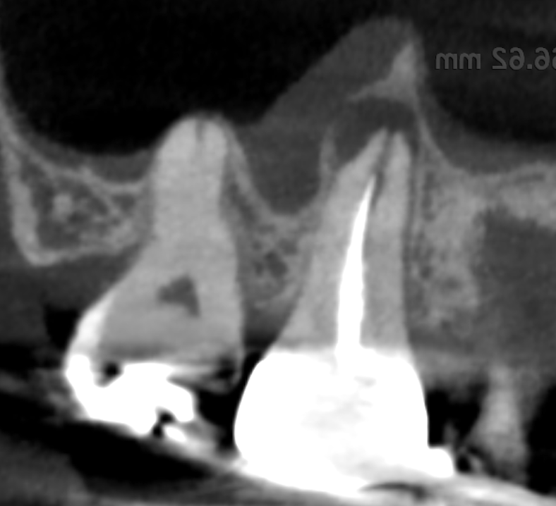 治療成功の可能性は？〜#3 Re-RCT - まつうら歯科医院 歯内療法専門室