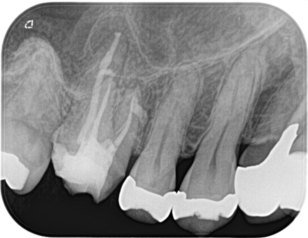 治療成功の可能性は？〜#3 Re-RCT - まつうら歯科医院 歯内療法専門室