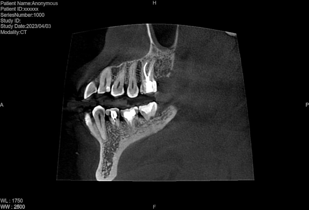 直接覆髄で石灰化した根管を有する歯の根管治療〜#14 RCT＋Core build up wo Fiber Post - まつうら歯科医院 歯 ...