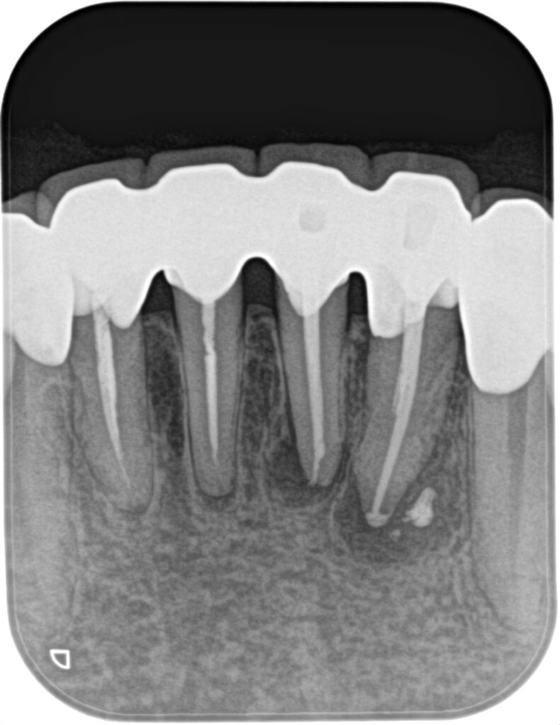 某美容歯科クリニックで行った治療のやり直し再根管治療〜#23,24,25,26 Re-RCTから約1年経過 - まつうら歯科医院 歯内療法専門室