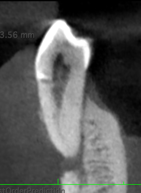 複雑な？根管を有するNecrosisの歯牙の攻略方法〜#21 RCT+Core build up - まつうら歯科医院 歯内療法専門室