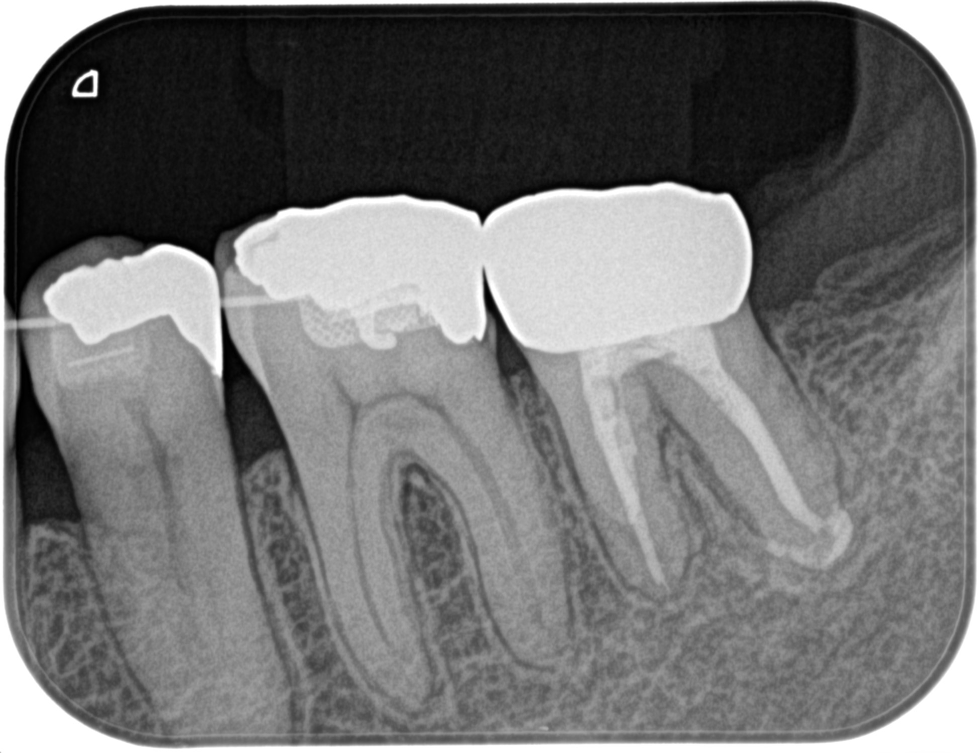 MB根にNi-Ti Rotaryファイルが破折しても…驚異的な治癒が起きた理由は？〜#18 Re-RCT 1yr recall - まつうら ...