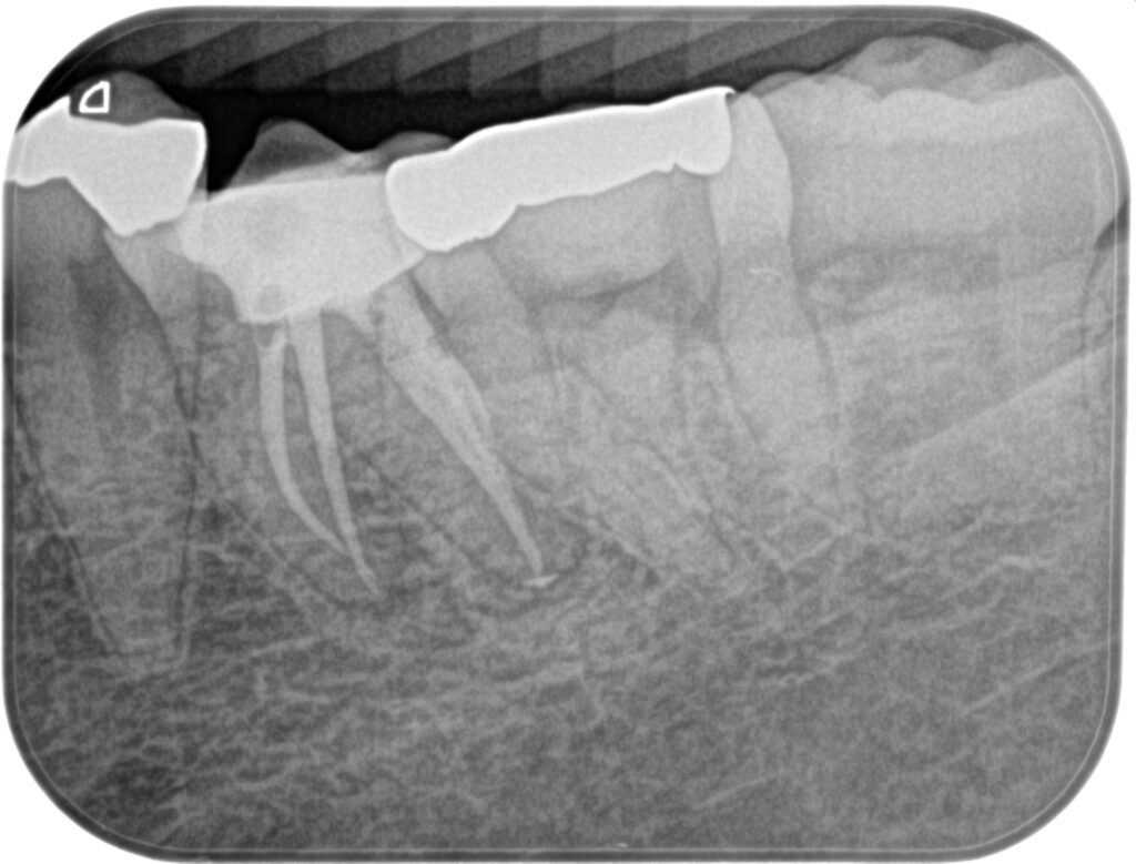 合流を再現するような根管形成と根管充填方法〜Previously initiated therapyの#19 RCT+Core build ...