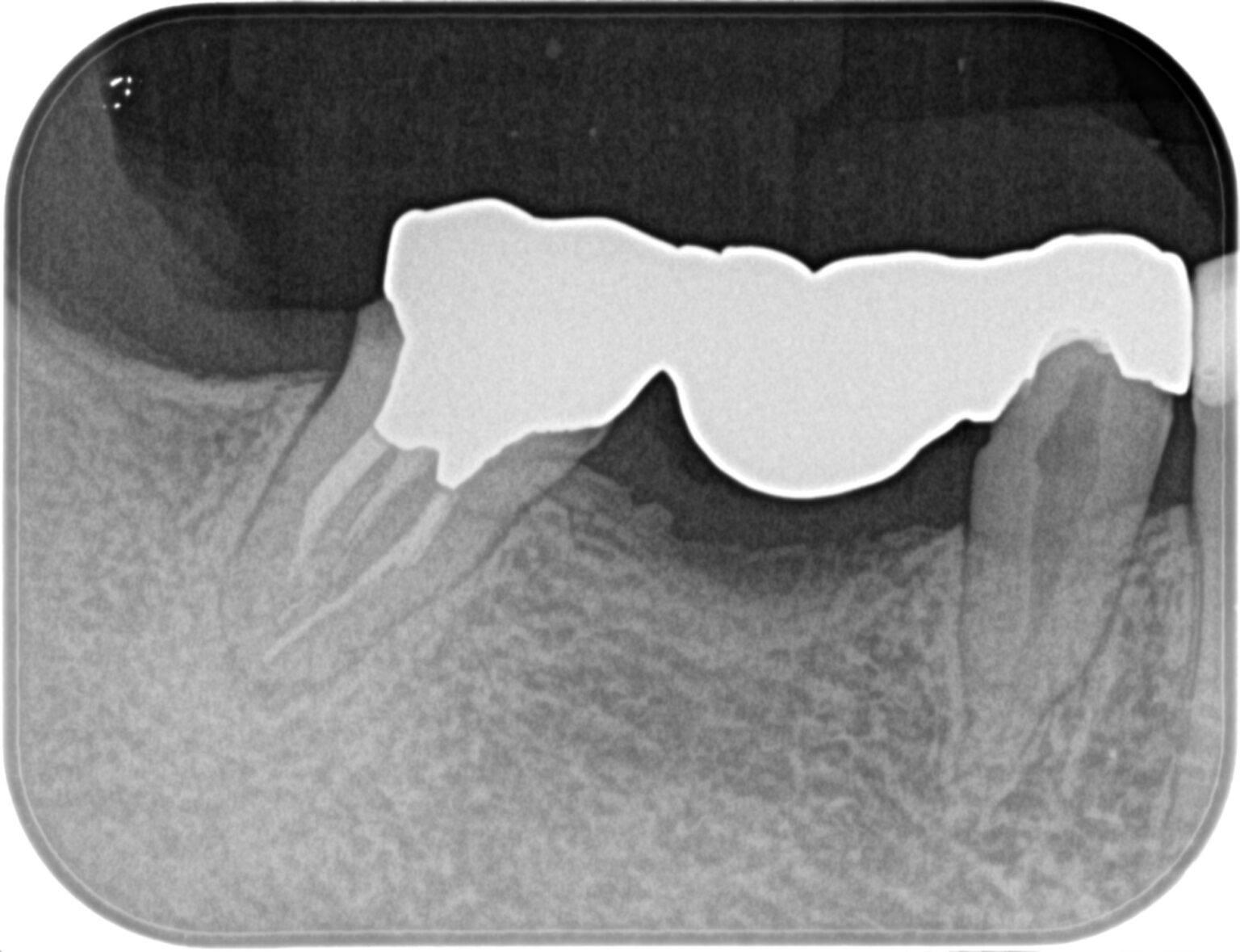 PAとCBCTの見え方の違いと樋状根の根管形態とは？〜#31 Re-RCT - まつうら歯科医院 歯内療法専門室
