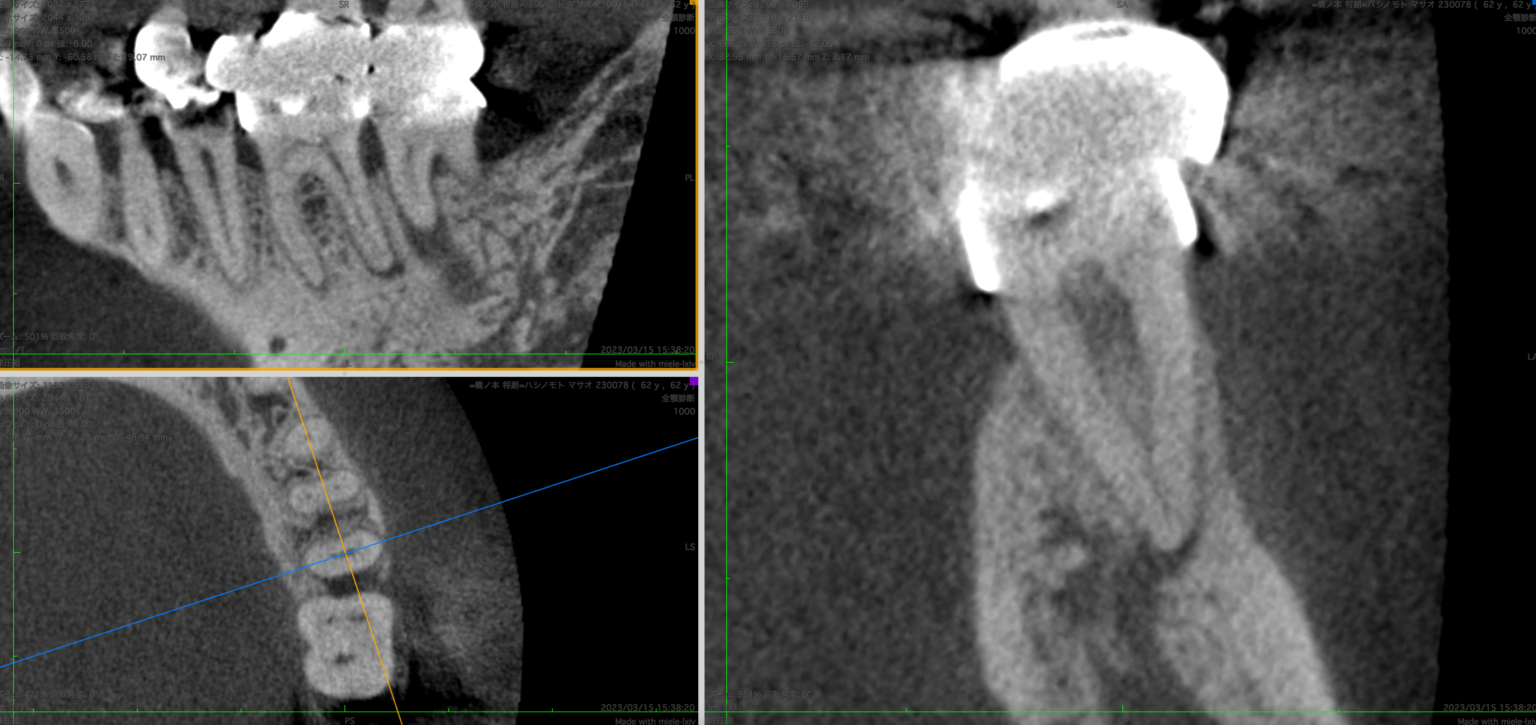 合流を再現した根管形成〜#19 RCT+Core build up - まつうら歯科医院 歯内療法専門室