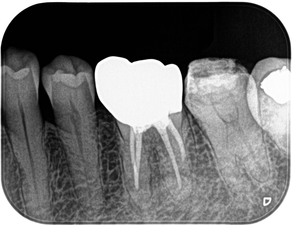 再根管治療の成功が "60%" に入る要因は？〜#19 Re-RCT 2yr recallから予想できること - まつうら歯科医院 歯内療法専門室