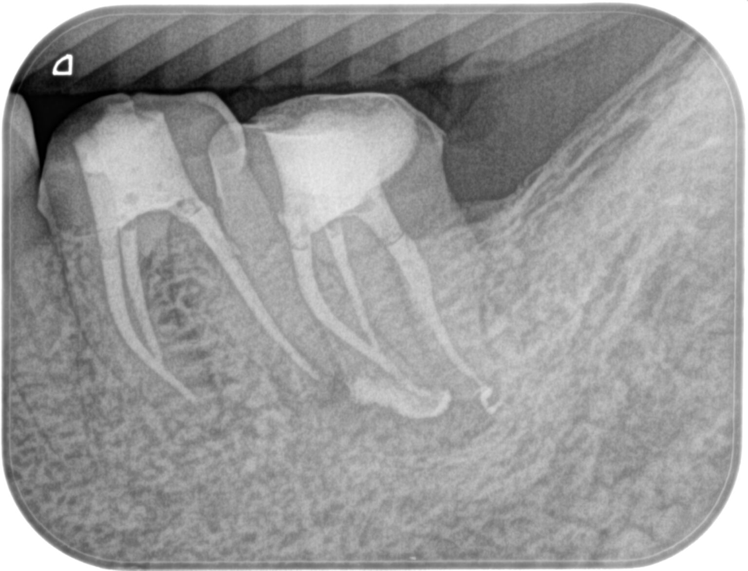 合流を再現した根管形成〜#19 RCT+Core build up - まつうら歯科医院 歯内療法専門室