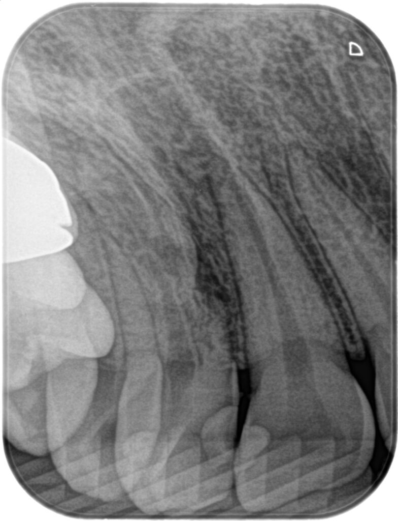 Invasive Cervical Root Resorptionの治療から1年経過〜#8 Intentional Replantation ...