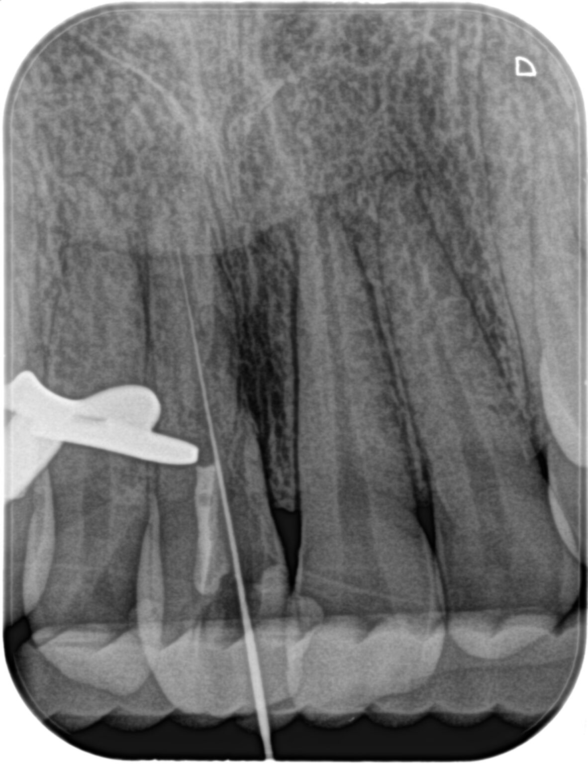 Invasive Cervical Root Resorptionの治療から1年経過〜#8 Intentional Replantation ...