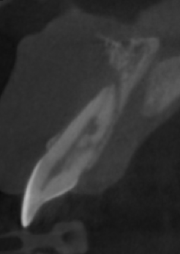 Invasive Cervical Root Resorptionの治療から1年経過〜#8 Intentional Replantation ...