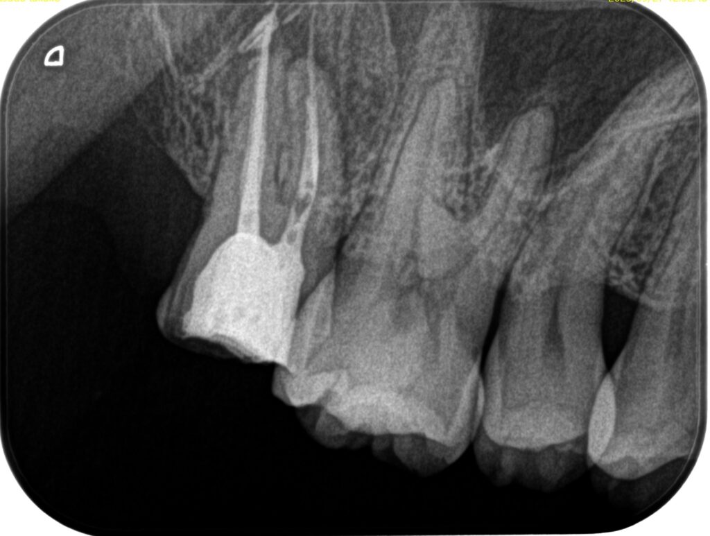 【加筆修正版】Re-RCTかIntentional Replantationか？どちらの治療方法か？その決定法とDB #40.04→#60. ...