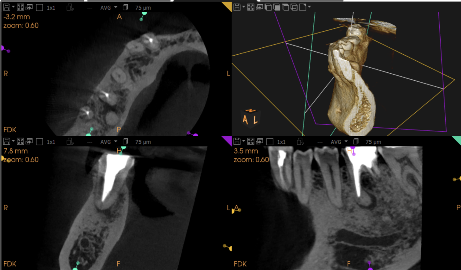 この歯は抜歯です？〜無麻酔で治療された#30 Previously initiated therapyのRCT - まつうら歯科医院 歯内療法専門室