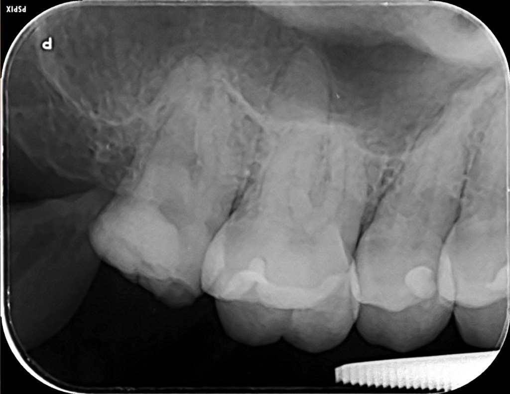 Previously Initiated therapyの根管治療から8年経過〜#2 RCT＋Perforation Repair ...
