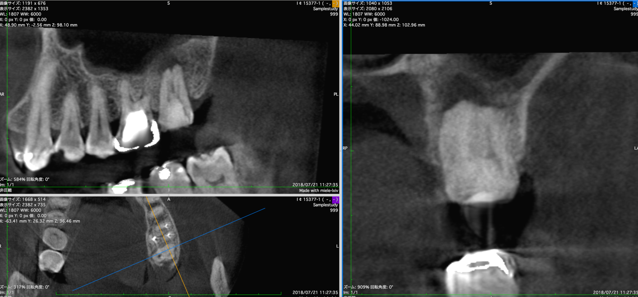 【加筆・修正】歯内療法におけるCBCTの1番のインパクトとは？〜#15 RCT 6yr recall - まつうら歯科医院 歯内療法専門室