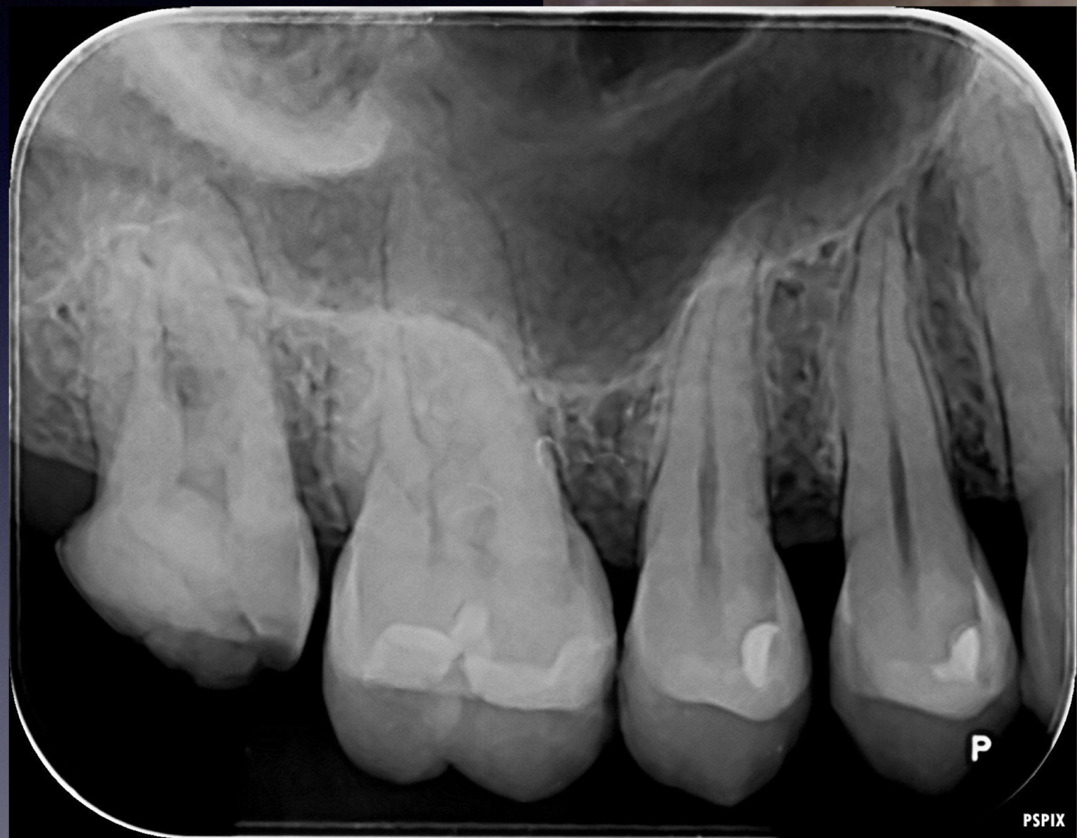 Previously Initiated therapyの根管治療から8年経過〜#2 RCT＋Perforation Repair ...