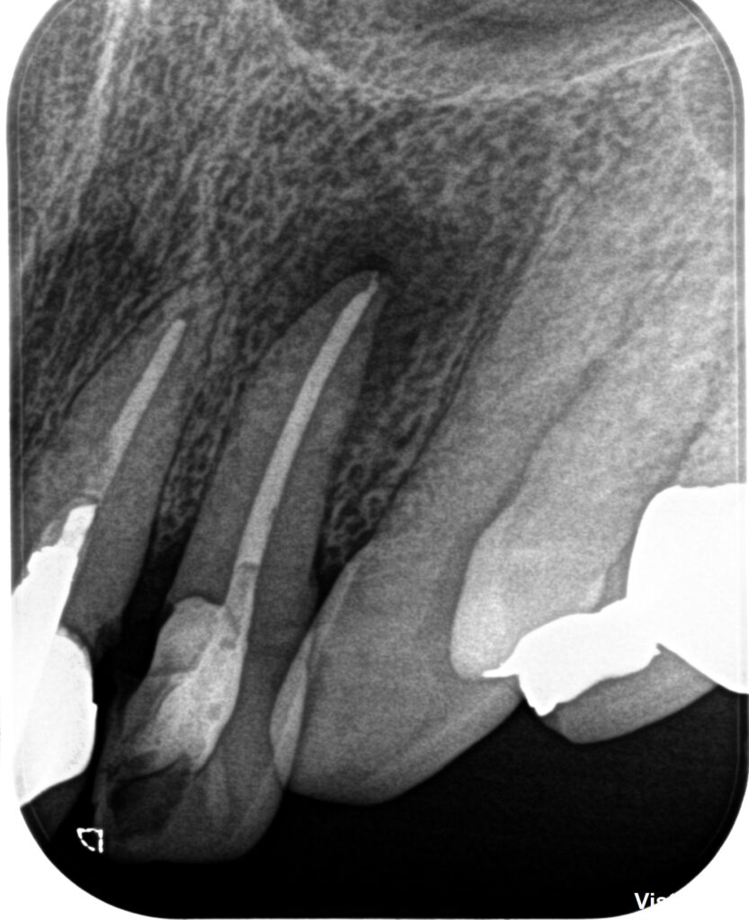 ヨシダ RE Fileを用いた10数分の#10 RCT 1回法 - まつうら歯科医院 歯内療法専門室