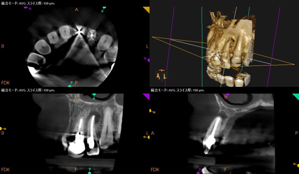 ヨシダ RE Fileを用いた10数分の#10 RCT 1回法 - まつうら歯科医院 歯内療法専門室