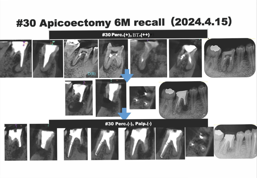 右下6のApicoectomyでも難易度が大幅に低下した理由とは？〜#30 Apicoectomy 6M recall - まつうら歯科医院 ...
