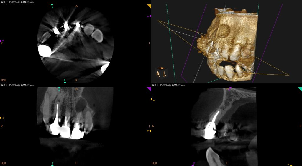 前歯が腫れて圧迫感がある…〜上顎前歯の歯根端切除術（#7,9 Apicoectomy）とそのFlap Designについて - まつうら歯科 ...