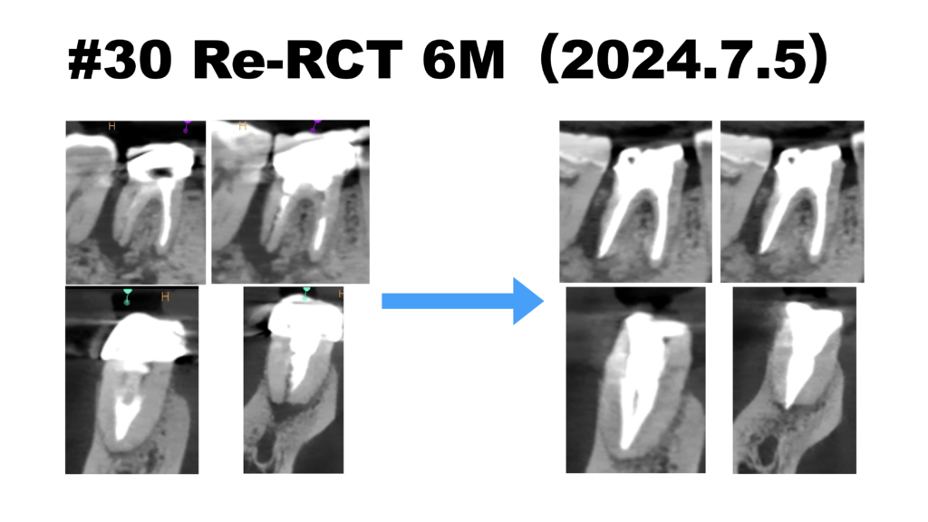 【非常勤歯科医師の歯内療法について】楕円根管の根管充填方法〜#30 Re-RCT(1回法) 6M recall - まつうら歯科医院 歯内療法専門室
