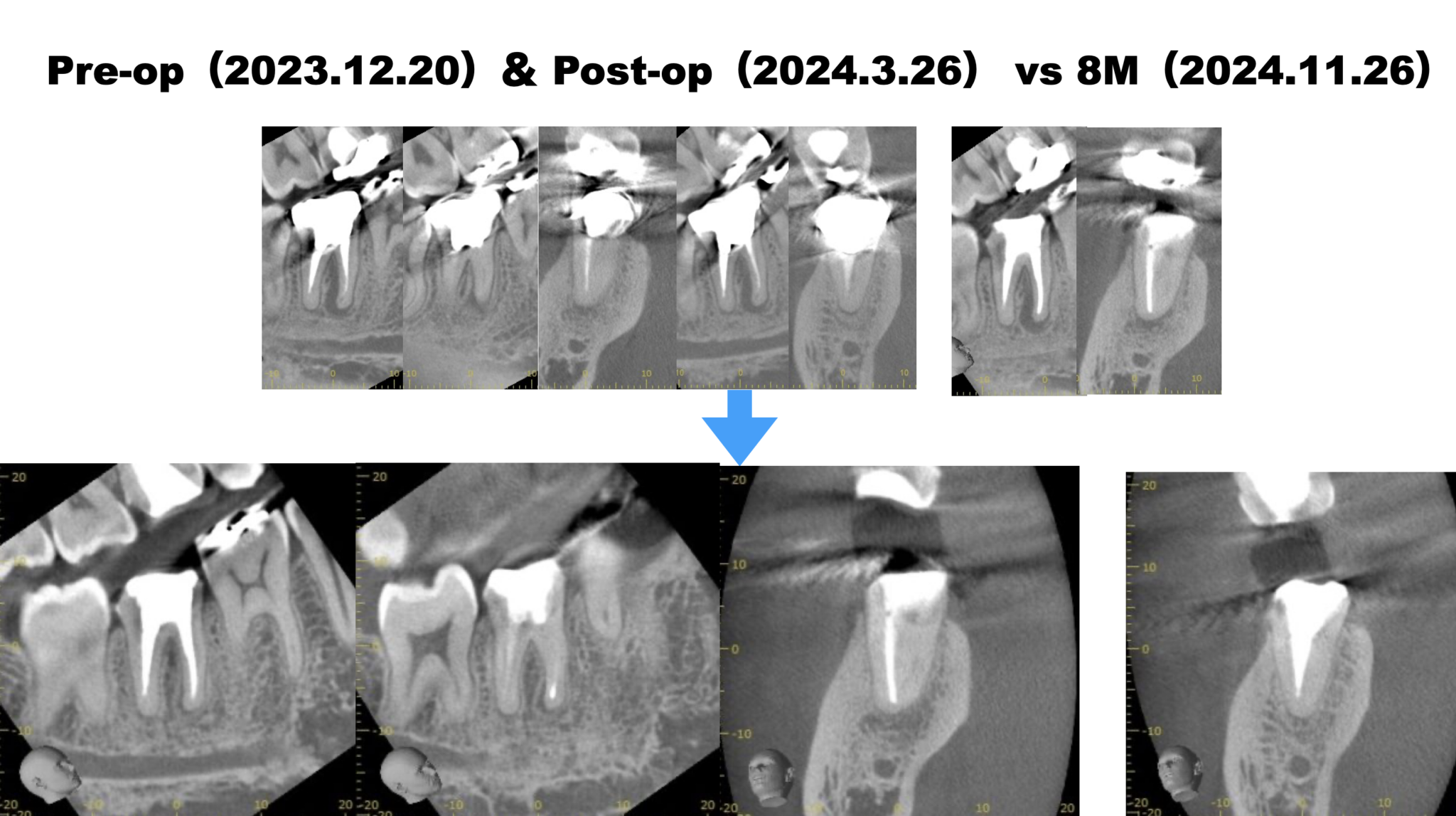 Sinus tractがある石灰化が亢進した歯牙の再根管治療（Selective Root Canal Re-treatment）〜#30 ...