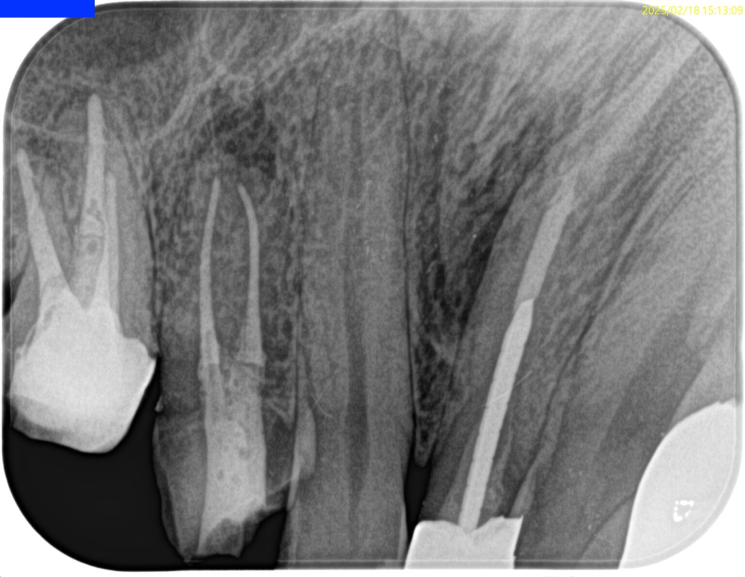 エンドエキスプローラーEX1はEndoGuide burの代用品になり得る！〜#3 Metal Post Core Removal+ Re ...