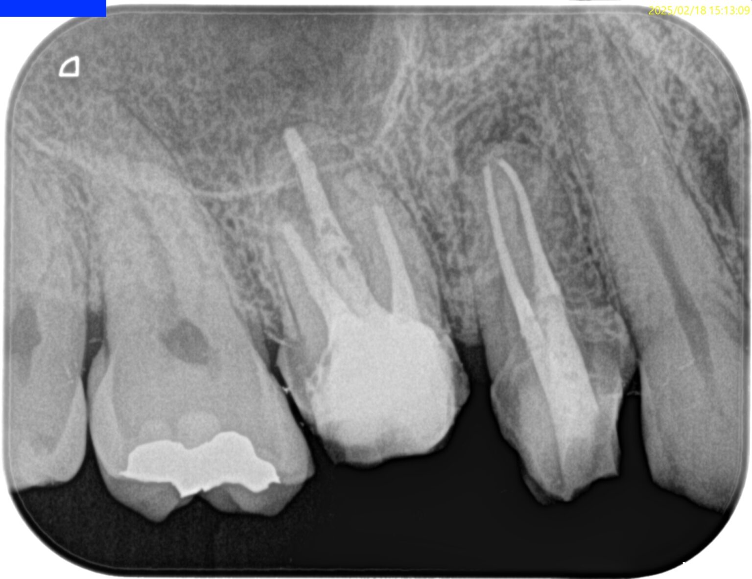 エンドエキスプローラーEX1はEndoGuide burの代用品になり得る！〜#3 Metal Post Core Removal+ Re ...